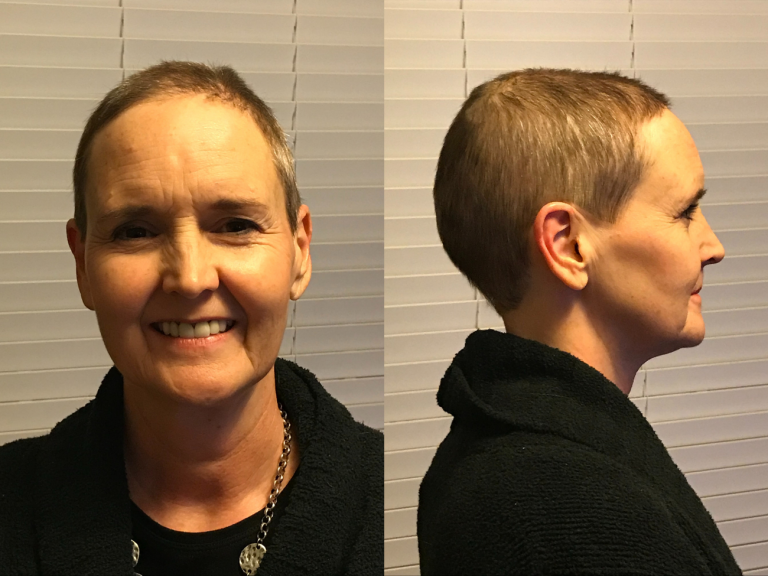 Should I Shave My Head? What You Need to Know About Hair Loss During ...